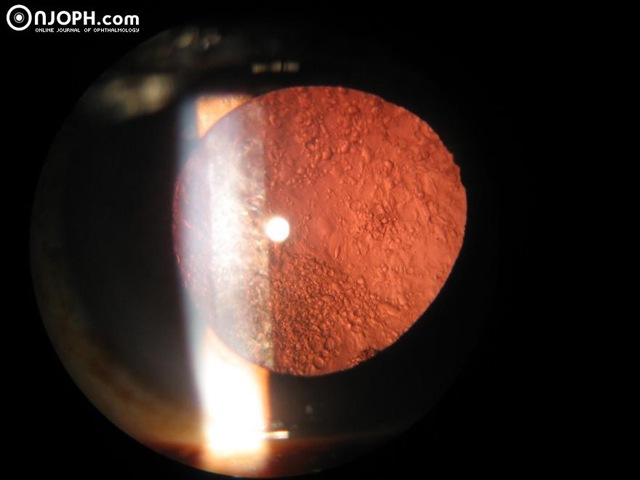 Medicine Decoded: Eponyms about Elschnig in Ophthalmology